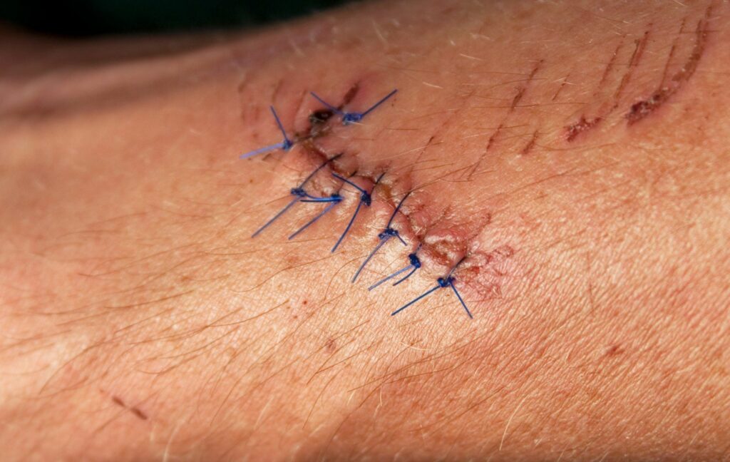 HCCPD170 Wound Closure and Suturing - EMS Education & Training