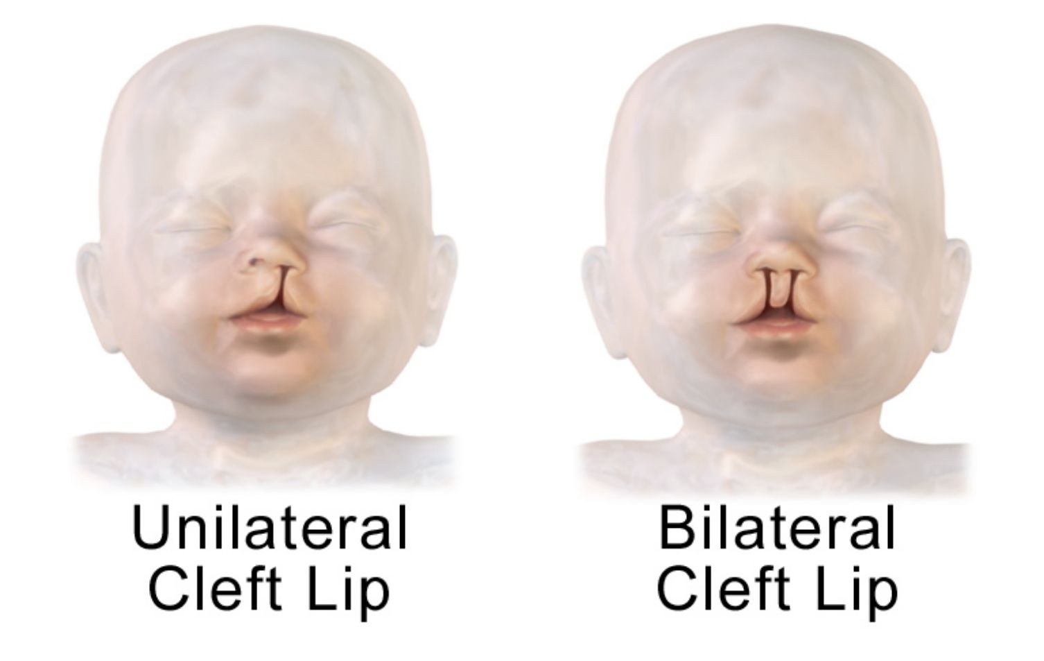 NUCPD038 Cleft Lip and Palate - EMS Education & Training