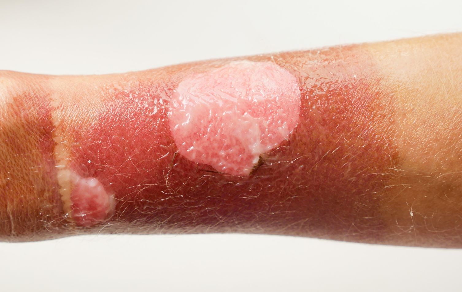 60SEC058 Assessment of Burn Depth: Grading Table - EMS Education & Training