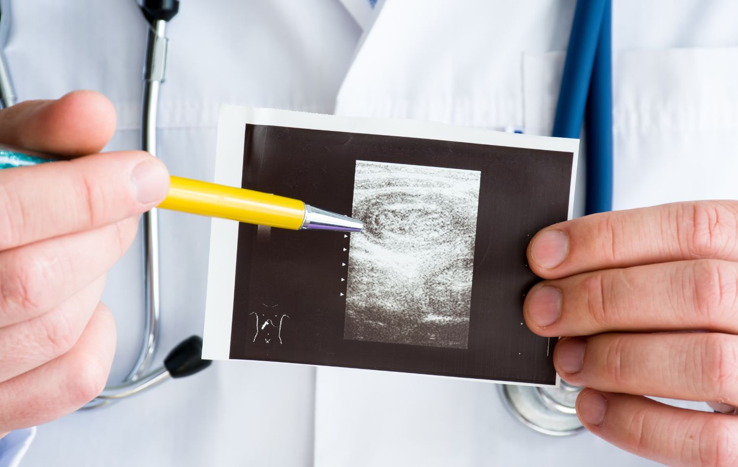 60SEC072 Intussusception: An Overview - EMS Education & Training